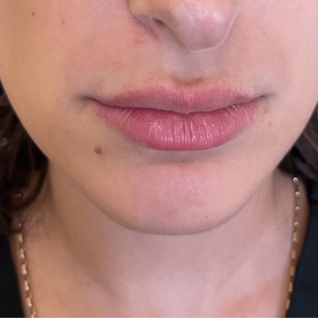 RHA Filler Beverly Hills - Facial Rejuvenation Beverly Hills